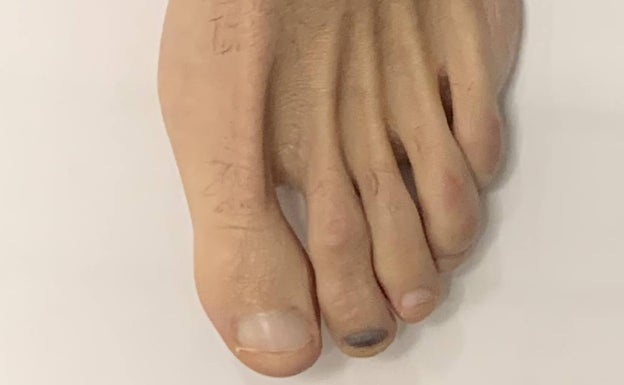 Running uñas negras | Cómo actuar ante la aparición de uñas negras en ...